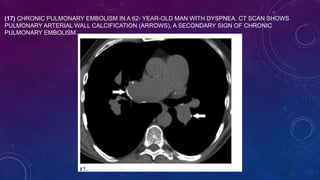 CT AnGIOGRAPHY of pulmonary embolism.pptx