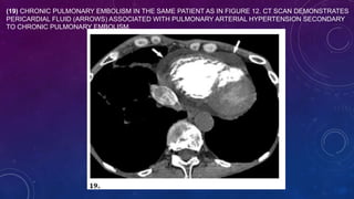 CT AnGIOGRAPHY of pulmonary embolism.pptx