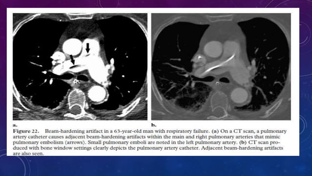 CT AnGIOGRAPHY of pulmonary embolism.pptx