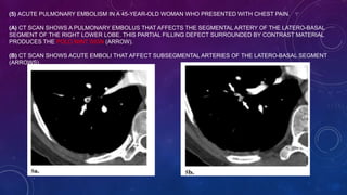 CT AnGIOGRAPHY of pulmonary embolism.pptx