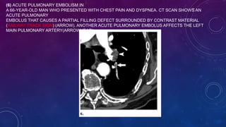 CT AnGIOGRAPHY of pulmonary embolism.pptx