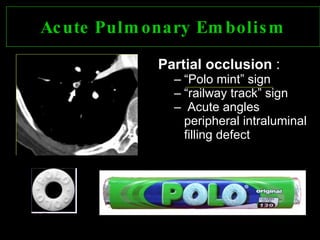 CTA OF PULMONARY EMBOLISM | PPT