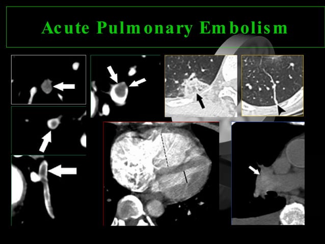 CTA OF PULMONARY EMBOLISM | PPT
