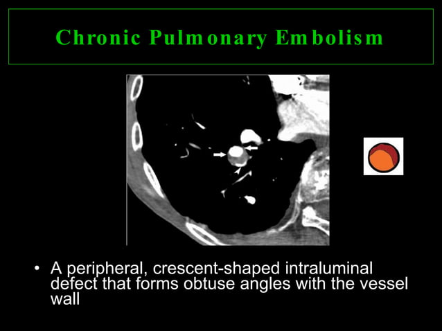 CTA OF PULMONARY EMBOLISM | PPT