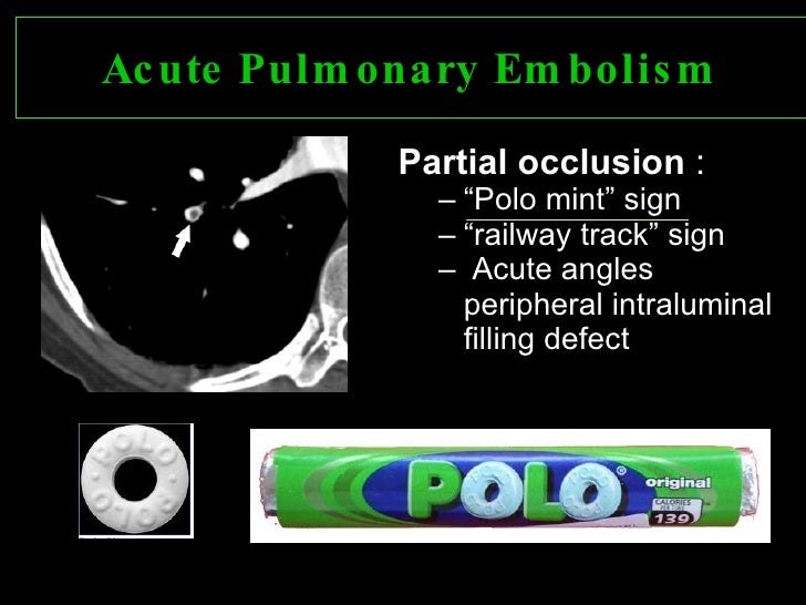 CTA OF PULMONARY EMBOLISM