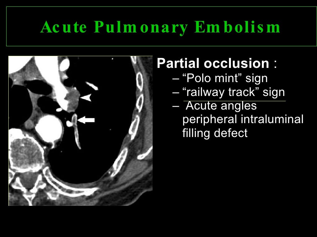 CTA OF PULMONARY EMBOLISM