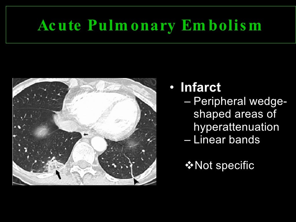 CTA OF PULMONARY EMBOLISM