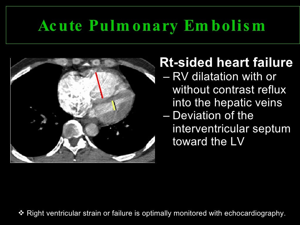 CTA OF PULMONARY EMBOLISM