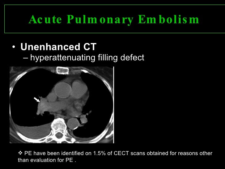 CTA OF PULMONARY EMBOLISM