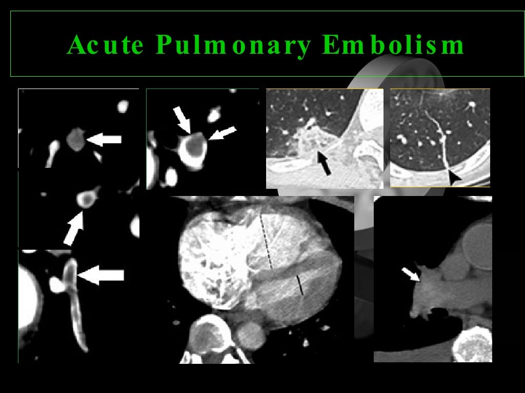 CTA OF PULMONARY EMBOLISM