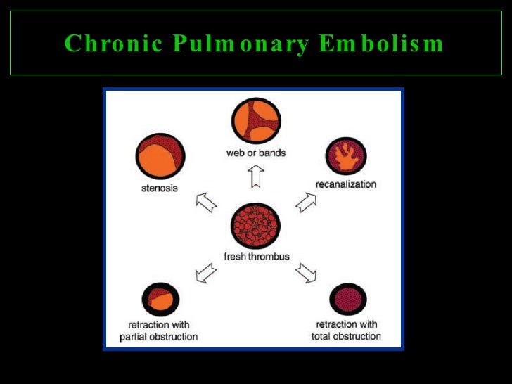 CTA OF PULMONARY EMBOLISM