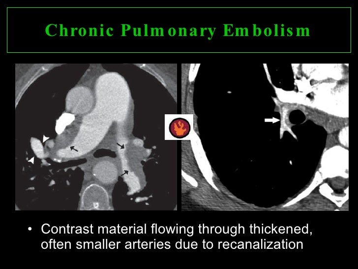 CTA OF PULMONARY EMBOLISM