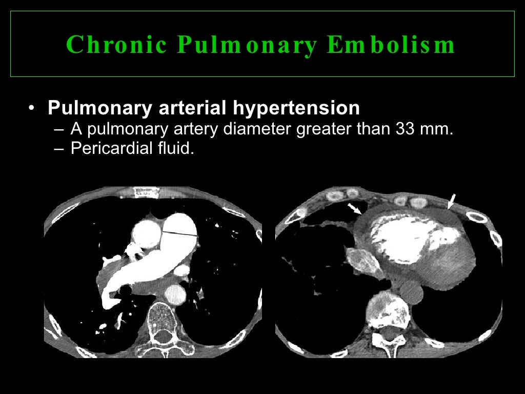 CTA OF PULMONARY EMBOLISM