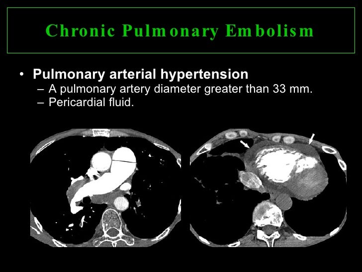 CTA OF PULMONARY EMBOLISM