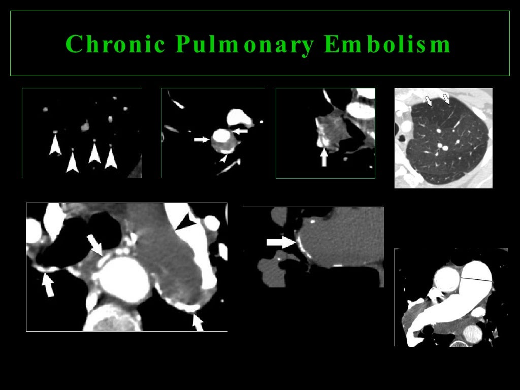 CTA OF PULMONARY EMBOLISM