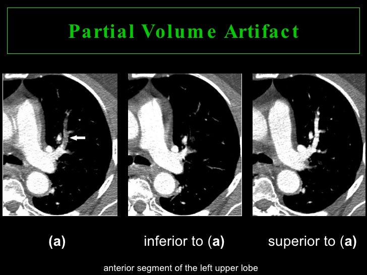 CTA OF PULMONARY EMBOLISM