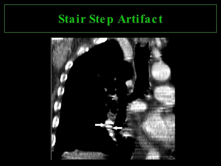 CTA OF PULMONARY EMBOLISM