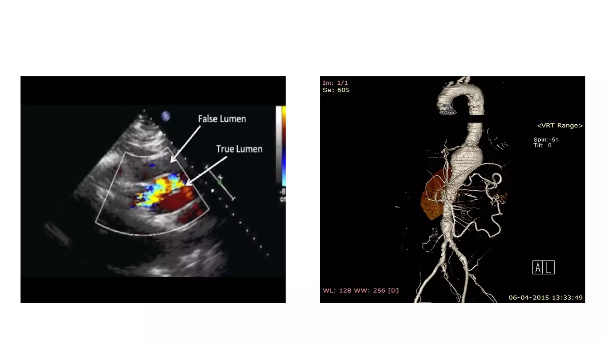 CT Aortogram For Aortic Dissection | PPS | Heart and Cardiovascular ...