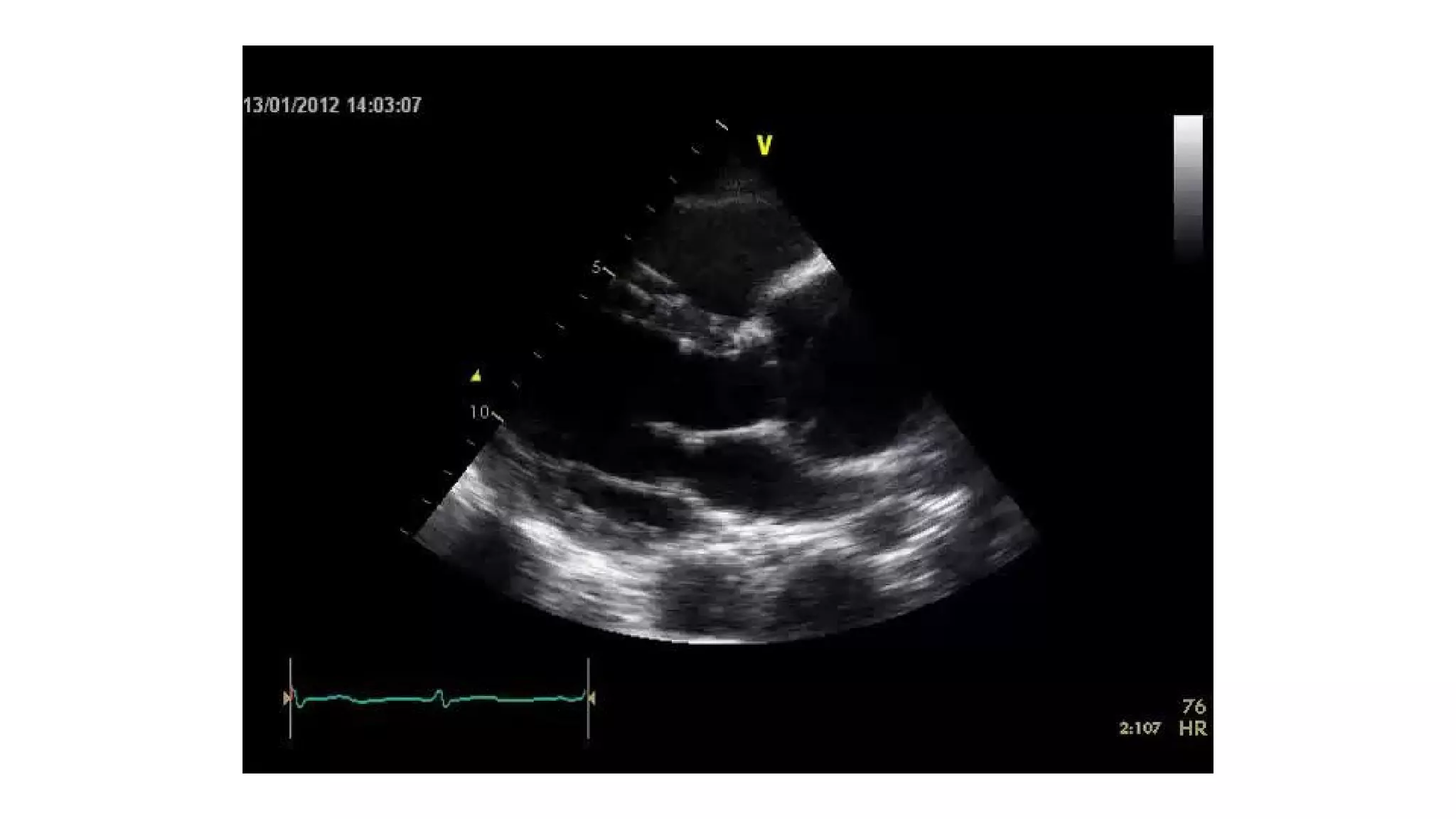 CT Aortogram For Aortic Dissection | PPS