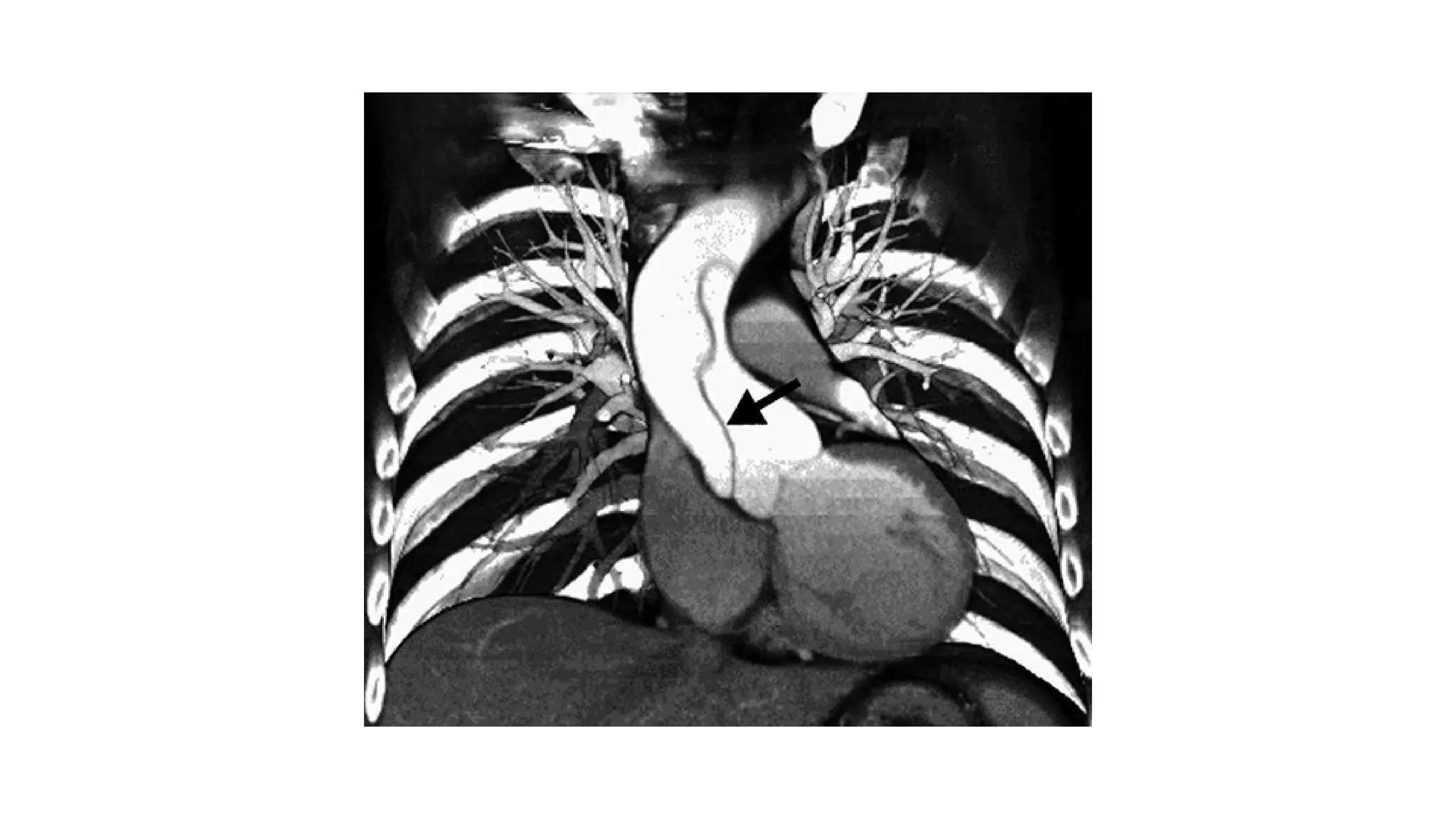 CT Aortogram For Aortic Dissection | PPS
