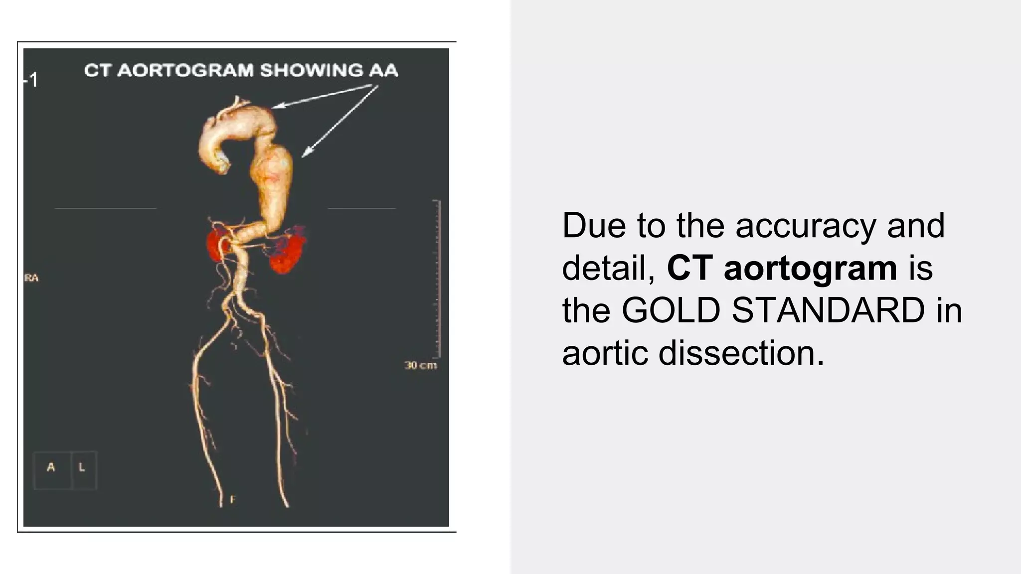 CT Aortogram For Aortic Dissection | PPS