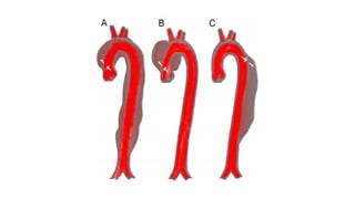 CT Aortogram For Aortic Dissection | PPS