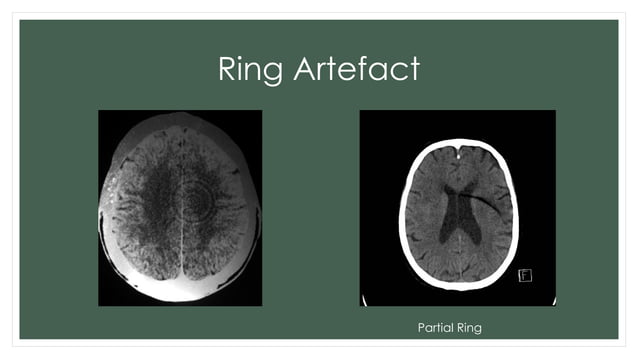 Ct artefacts_urooj Mushtaq Bhat 021.pptx