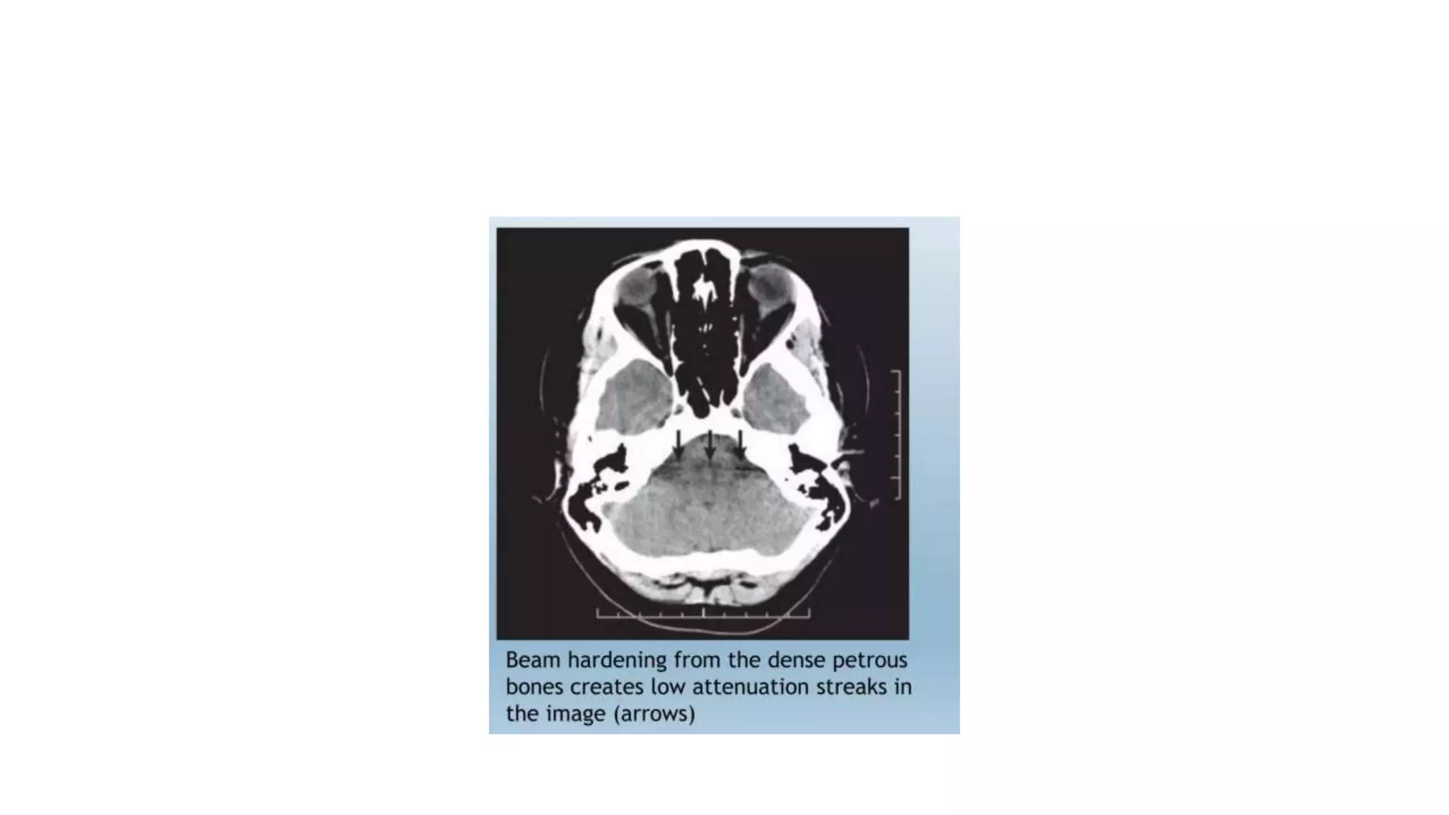 Ct Artifactspptx