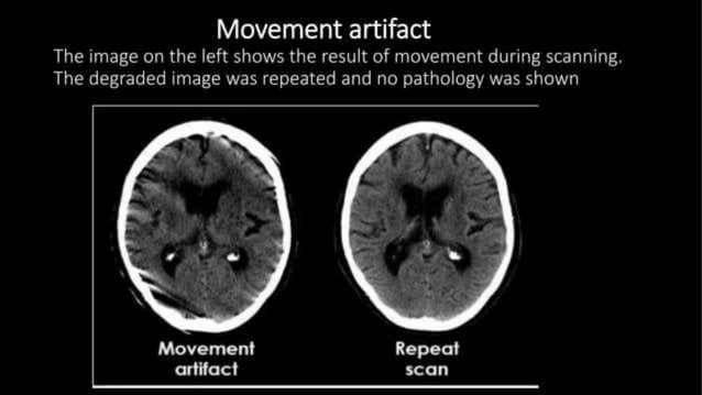 CT ARTIFACTS.pptx