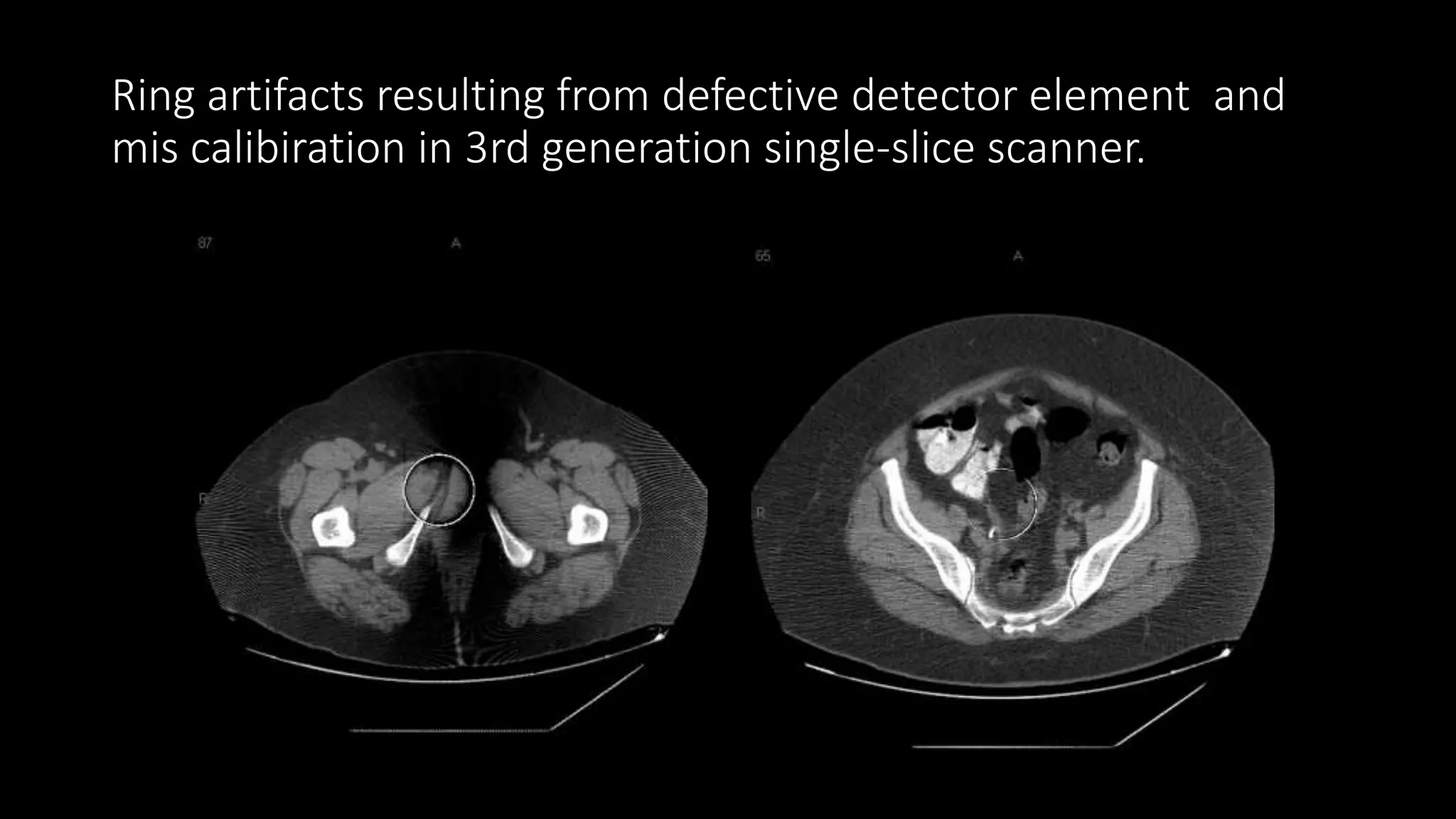 CT artifact | PPTX