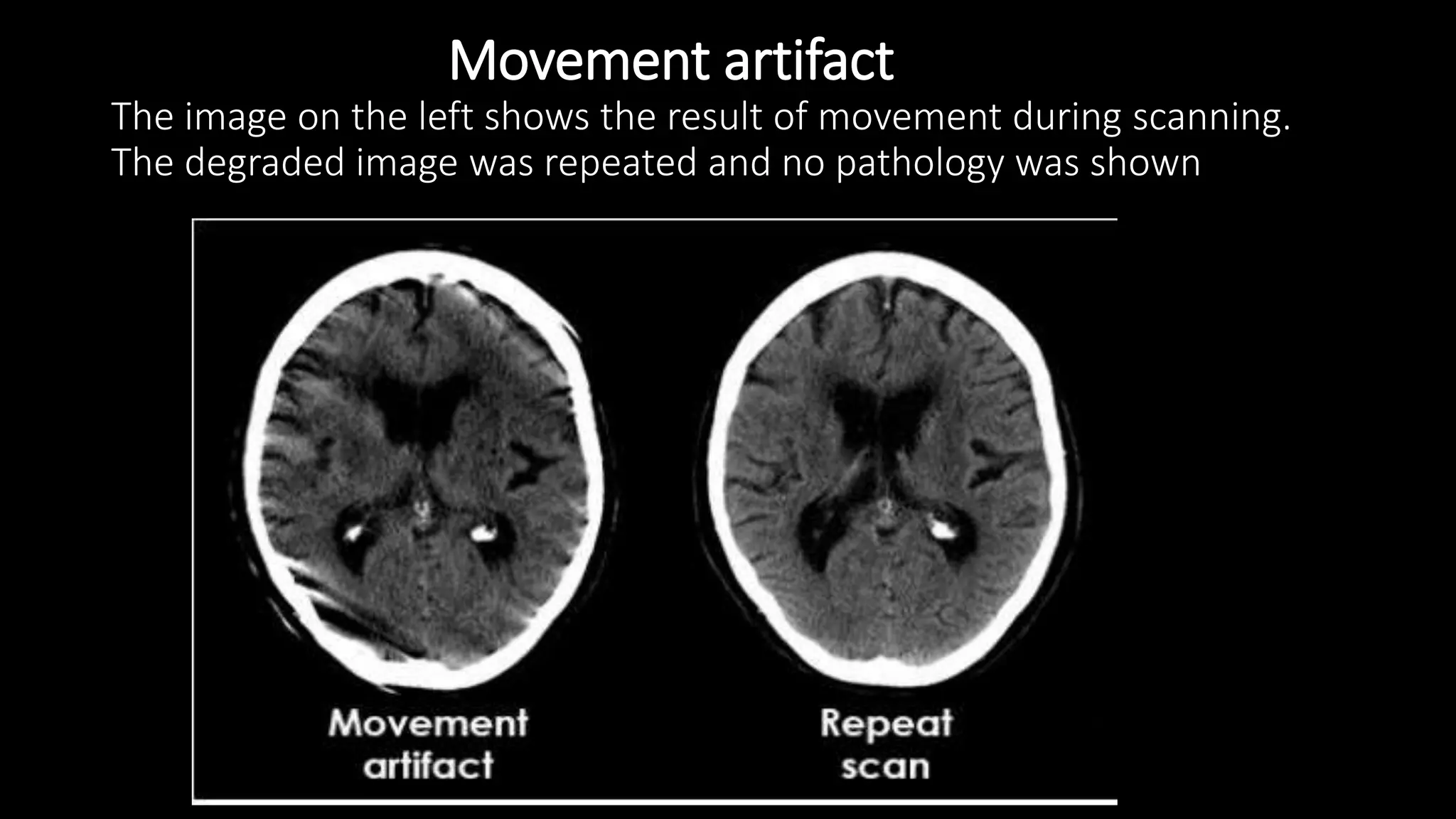 CT artifact | PPTX