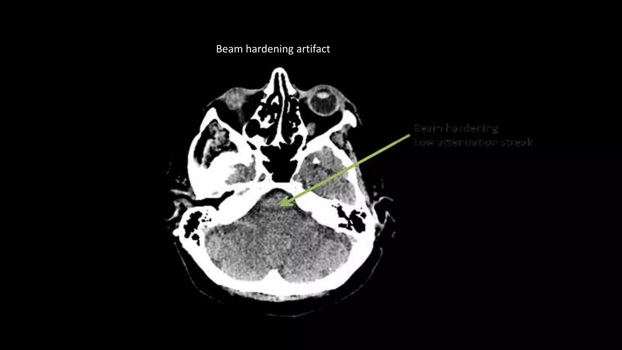 CT artifact | PPTX