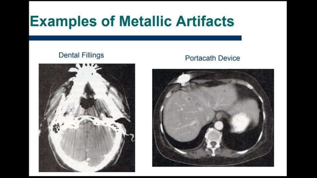 CT artifact | PPT