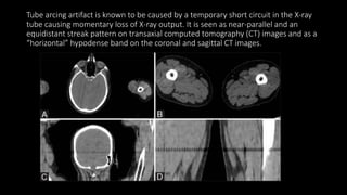 CT artifact | PPTX