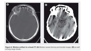 DIFFERENT TYPES OF RADIOGRAPHY CT_ARTIFACTS | PPTX