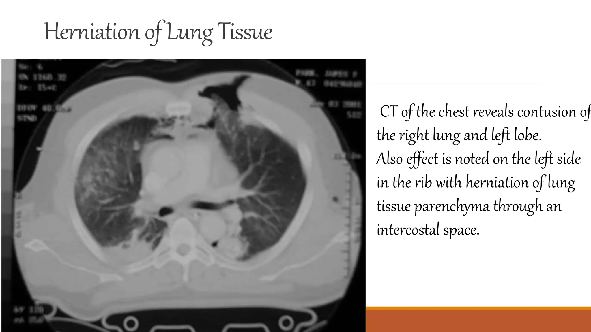 Ct blunt chest trauma | PPTX