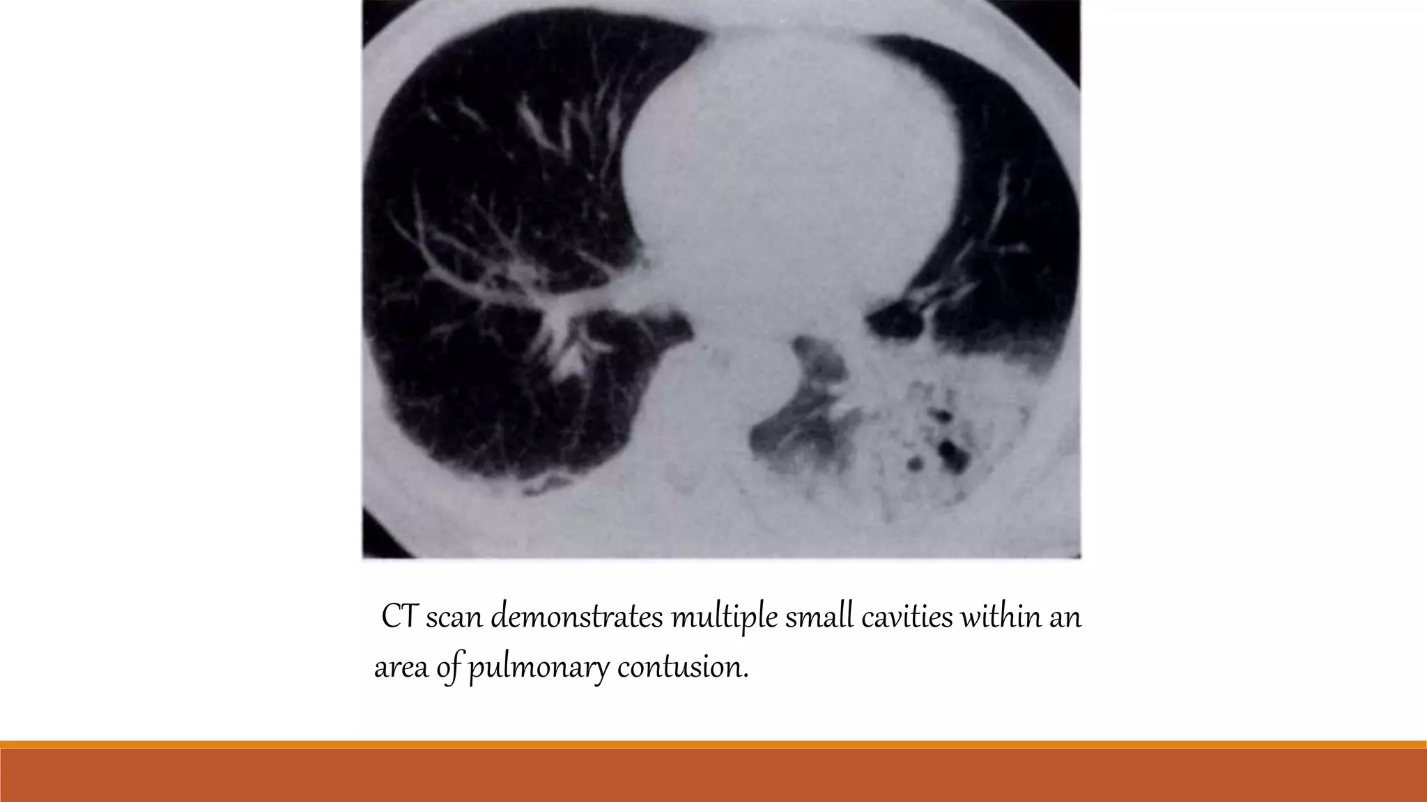 Ct blunt chest trauma | PPT