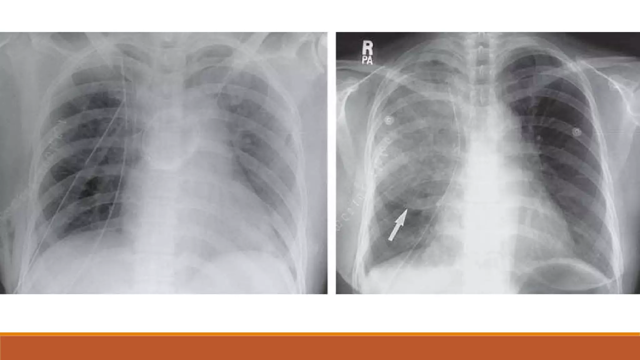Ct blunt chest trauma | PPT