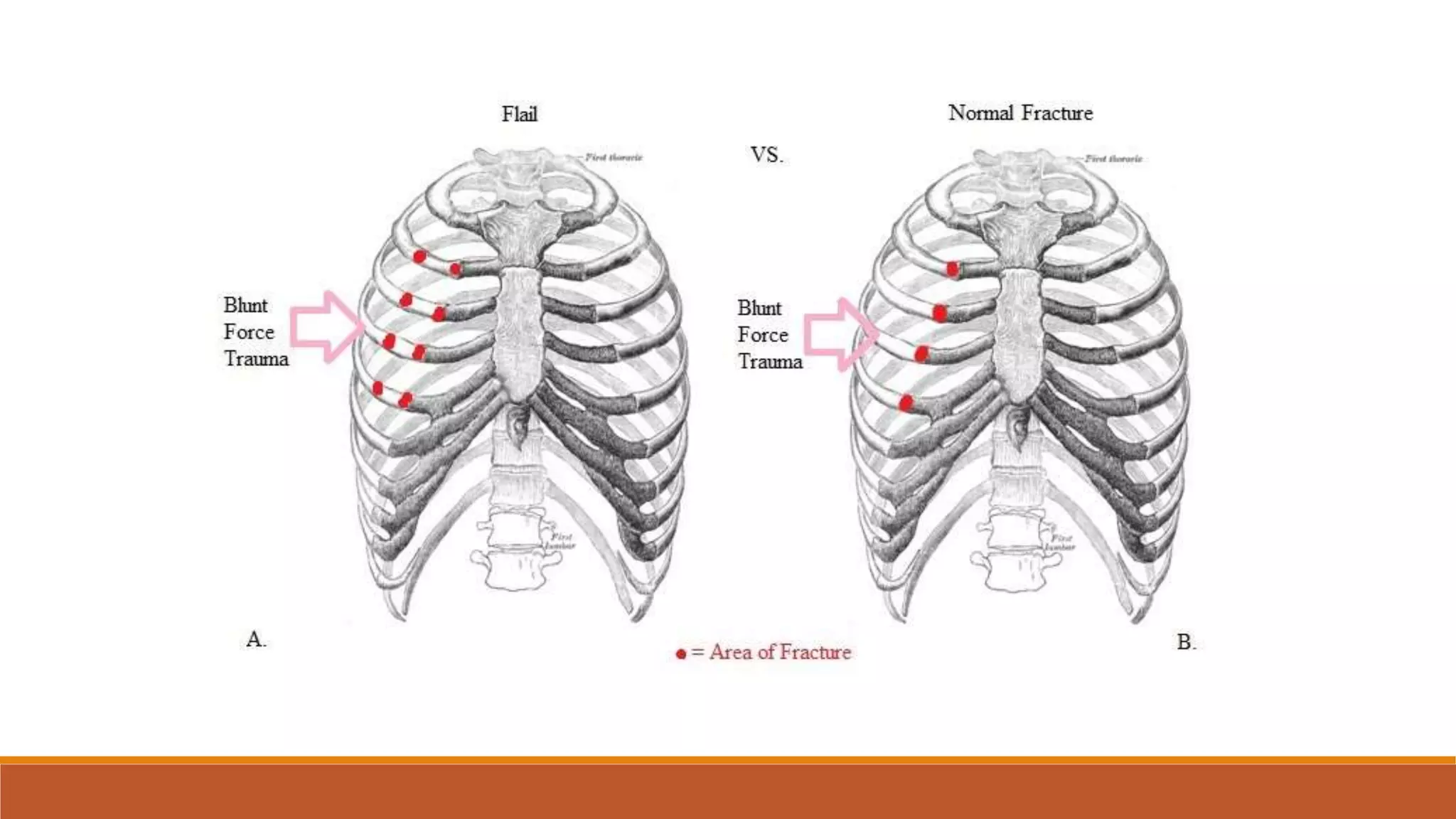 Ct blunt chest trauma | PPTX