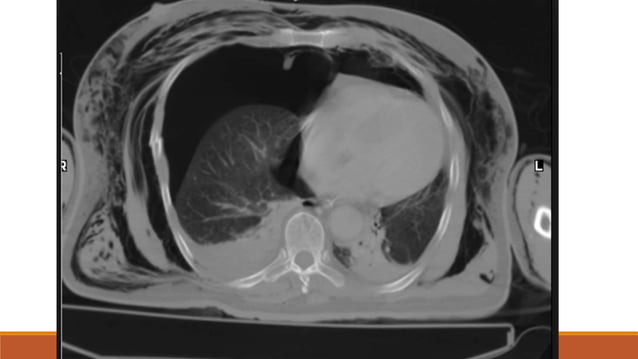 Ct blunt chest trauma | PPT