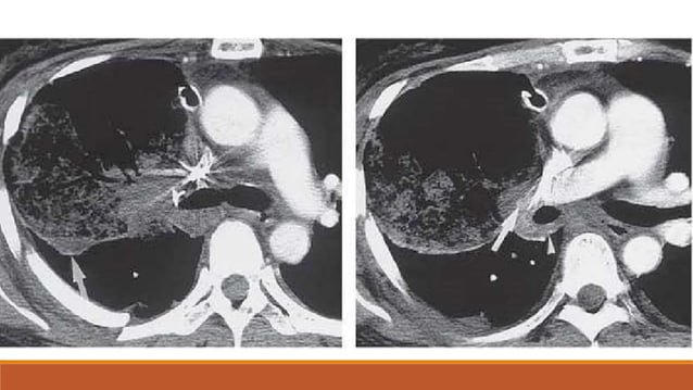 Ct blunt chest trauma | PPT