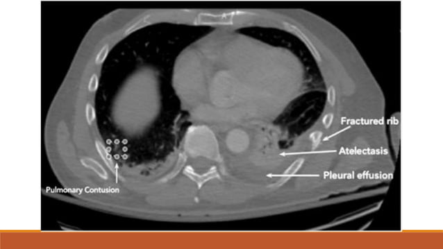 Ct blunt chest trauma | PPT