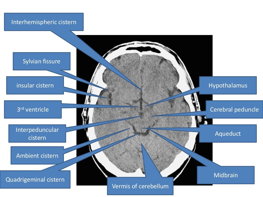 Ct brain by prof. Wael samir