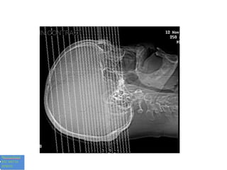 Ct image of brain | PPT