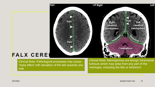 Radiological anatomy of brain.pptx | Brain and Nervous System Disorders ...