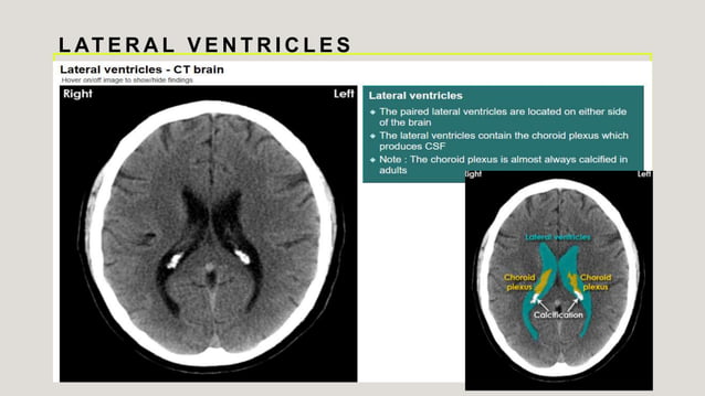 Radiological anatomy of brain.pptx | Brain and Nervous System Disorders | Diseases and Conditions