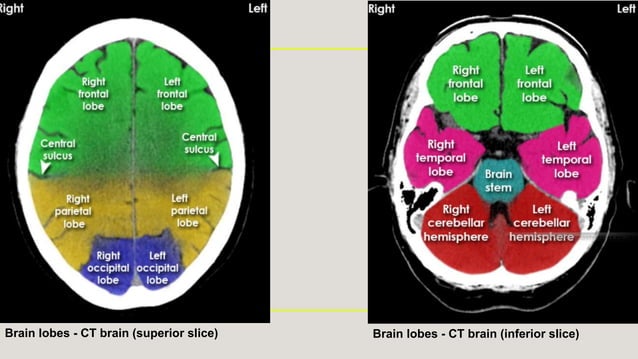 Radiological anatomy of brain.pptx | Brain and Nervous System Disorders | Diseases and Conditions