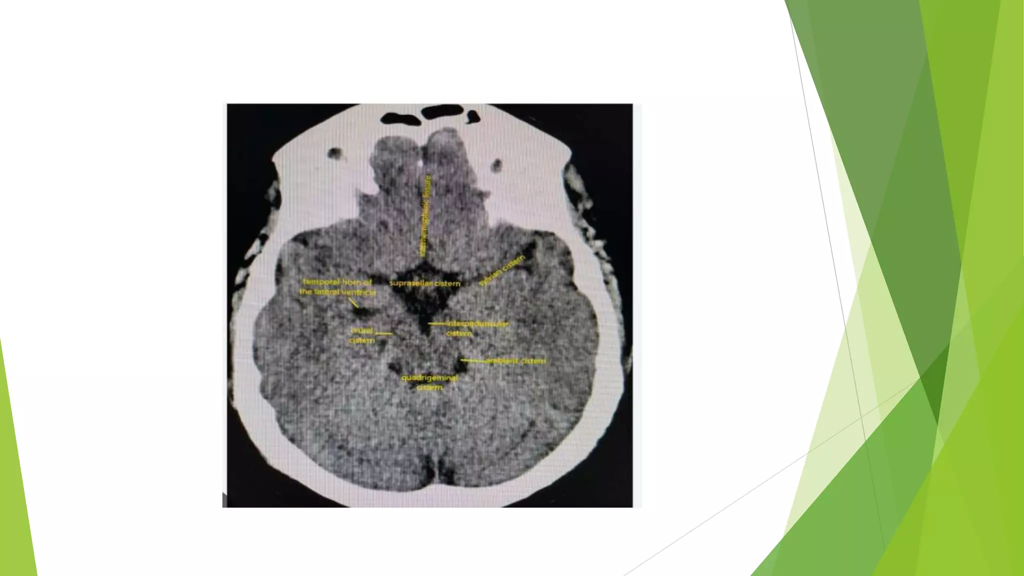 CT BRAIN-ANATOMY AND VASCULAR SUPPLY-FINAL PPT.pptx