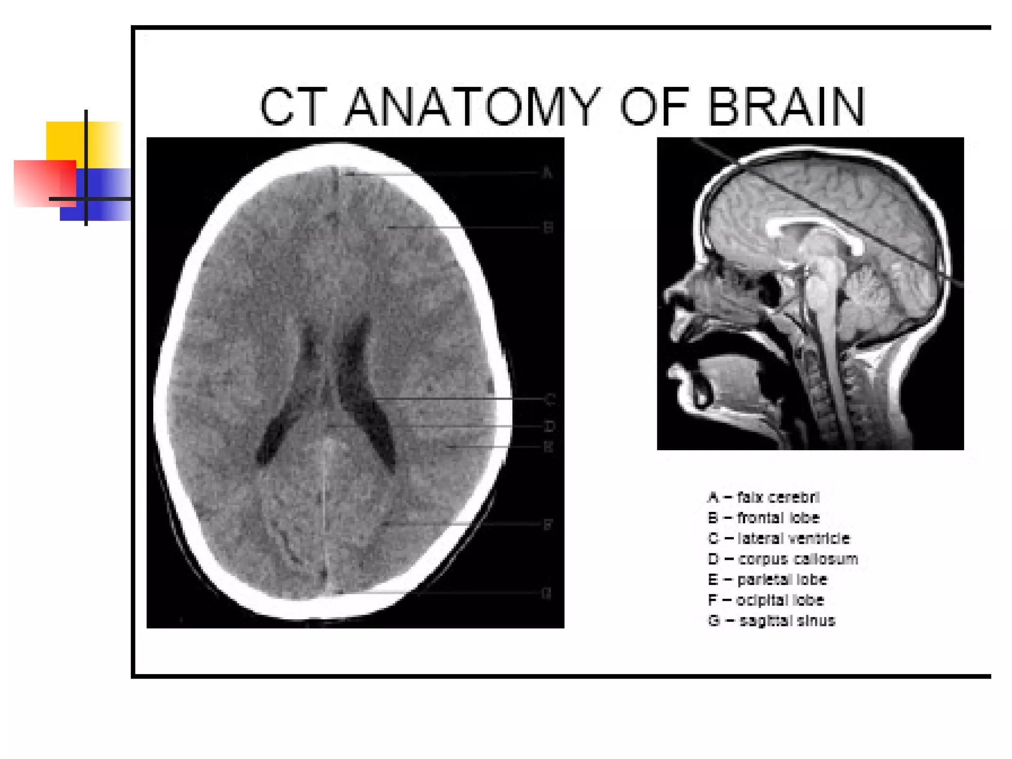 Ct brain basics and anatomy | PPT