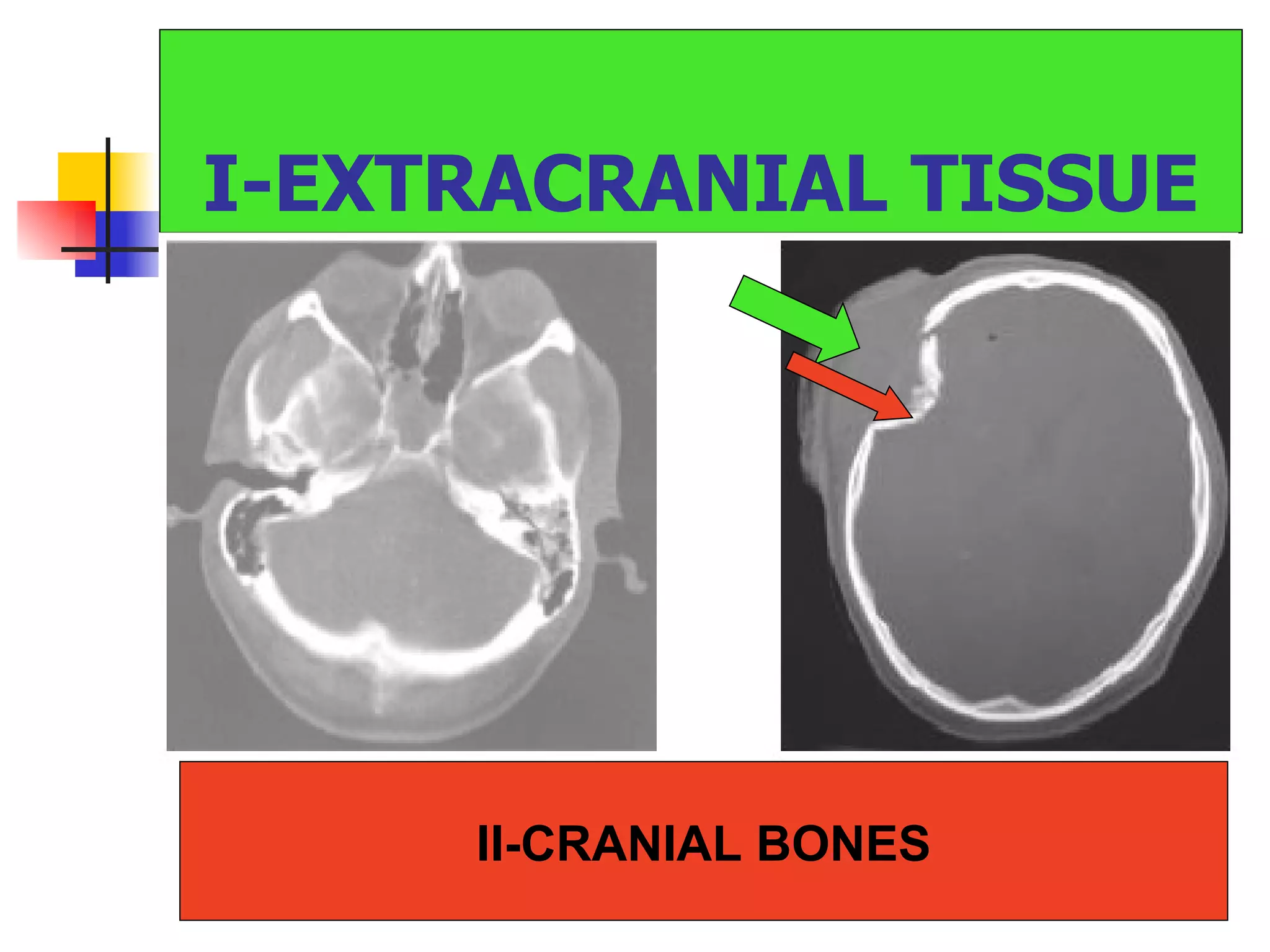 Ct brain basics and anatomy | PPT